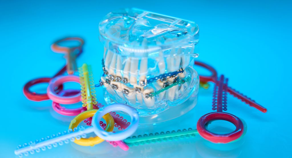 Orthodontic Appliances | Smile Life